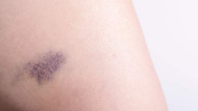 Prellungen behandeln - Was hilft gegen eine Prellung? | FLEXEO